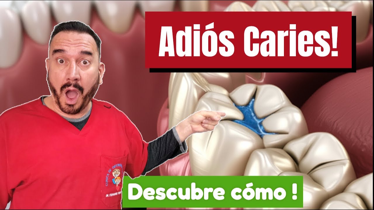 ¡Evita Caries en Niños con este sencillo Truco! SELLADORES de Fosetas ...