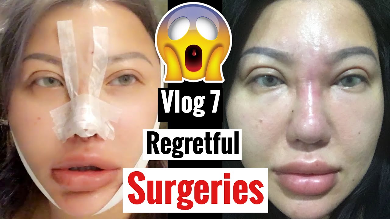 REGRETFUL SURGERIES | PERMANENT FILLERS AQUAMID | VLOG EP7 - YouTube