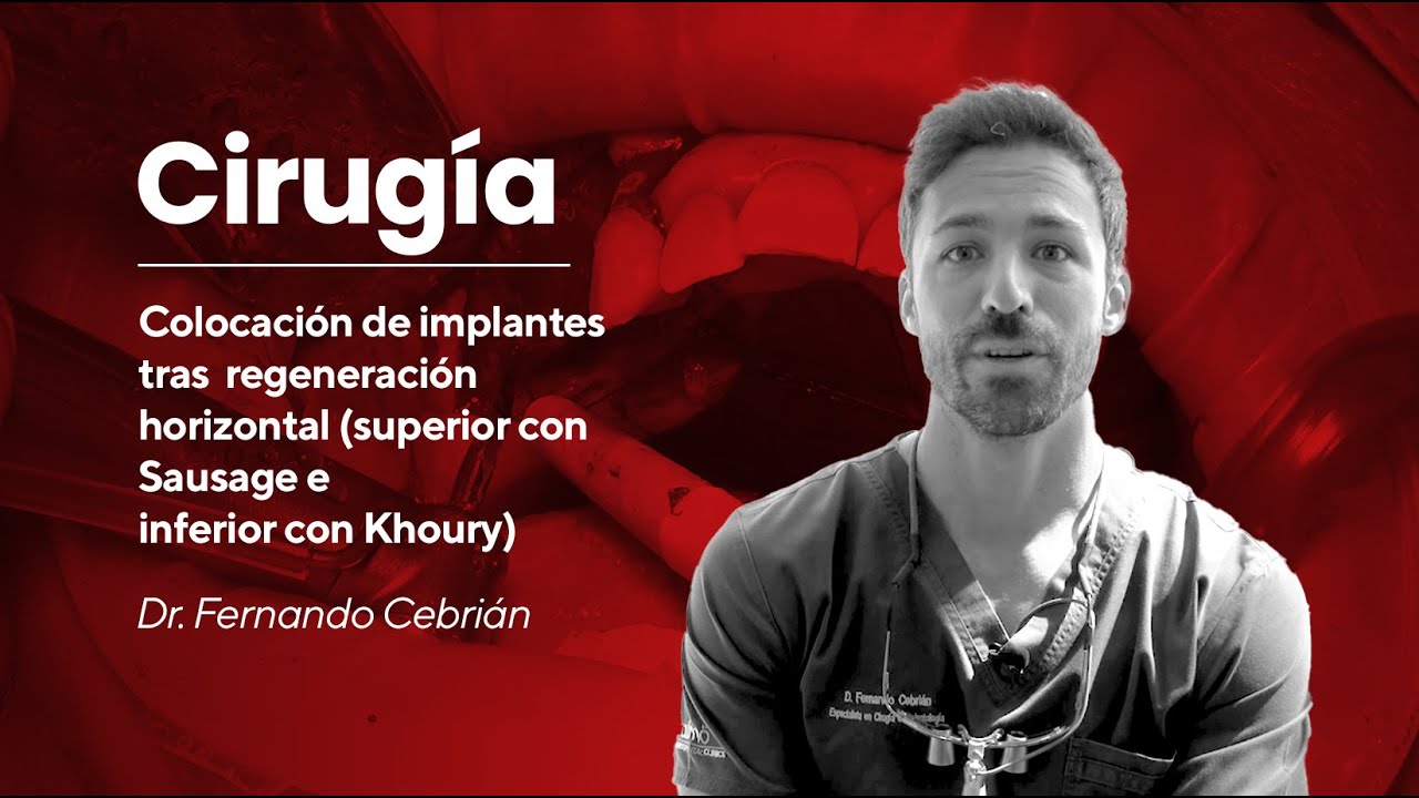 🔴[CIRUGÍA]🦷 Colocación de implantes tras regeneración horizontal - Dr ...