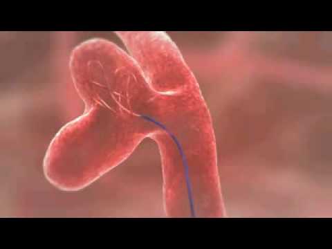 Coiling Aneurysms Animation - YouTube