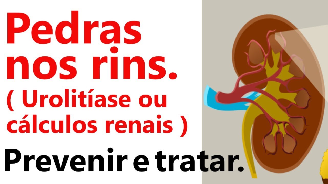 🟨 PEDRA NOS RINS, UROLITÍASE OU CÁLCULOS RENAIS. PREVENÇÃO E TRATAMENTO ...