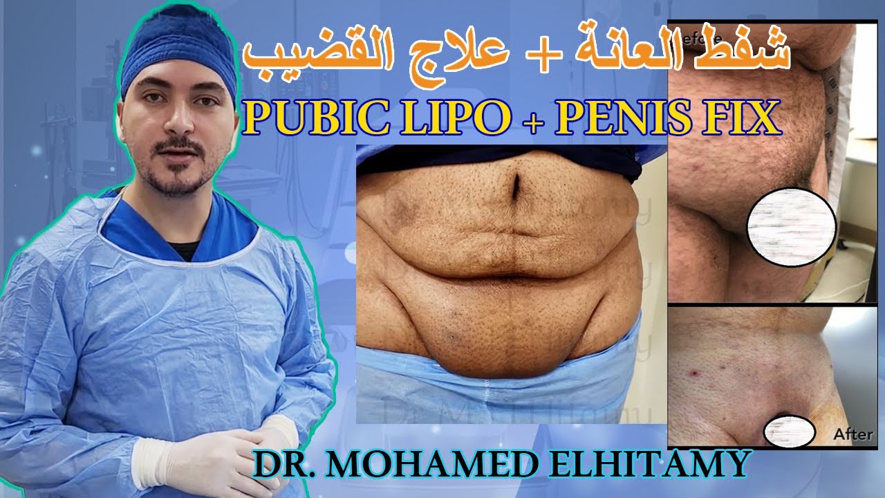 شفط دهون العانة وعلاج القضيب المدفون في ١٥ دقيقة Pubic Fat Removal ...