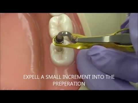 Amalgam restoration class 1 - YouTube