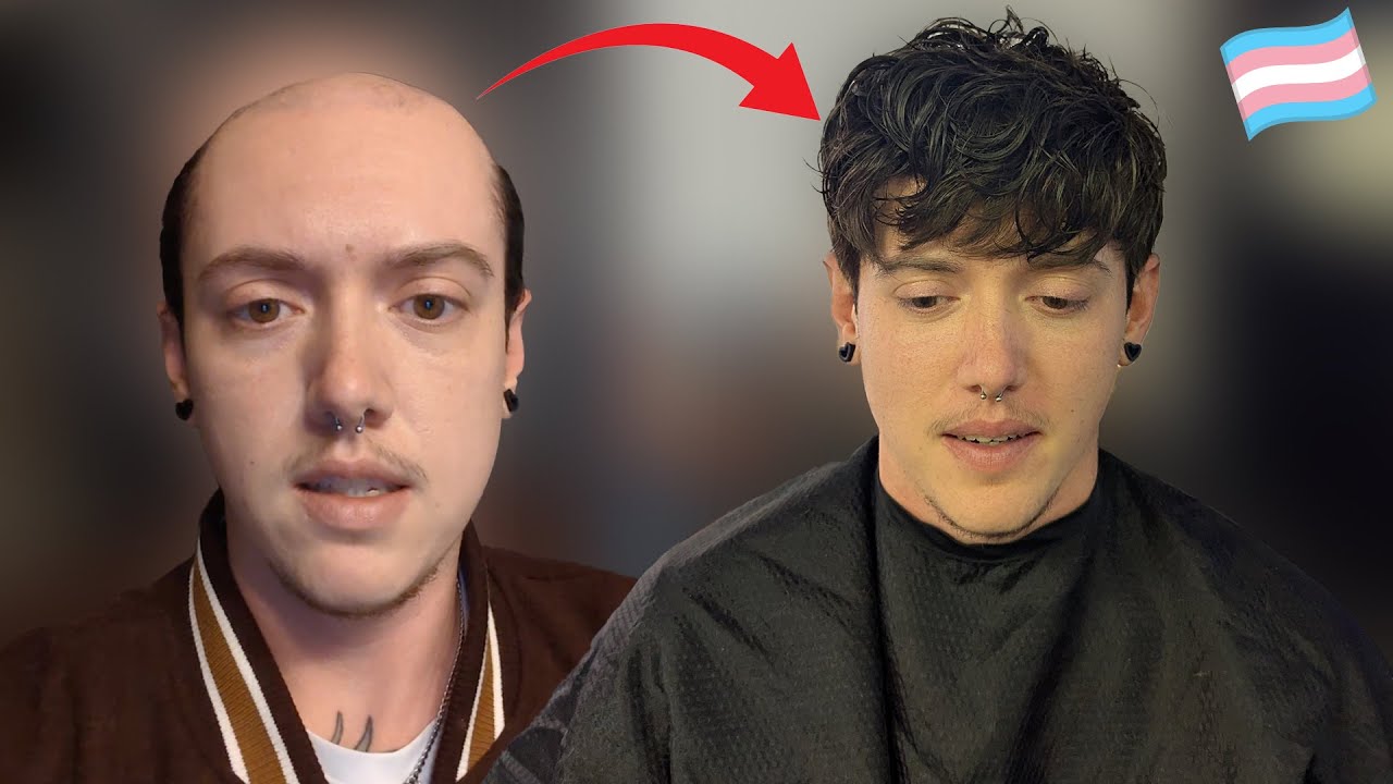 He Was Losing His Hair Fast… Until He Tried THIS 😳 (You Won’t Believe It’s Not Real!) - YouTube