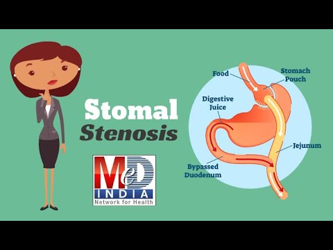 Stomal Stenosis - YouTube
