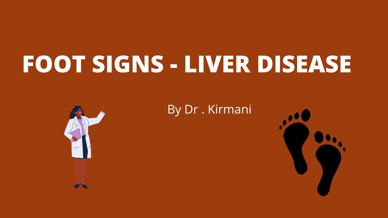 Foot Signs Liver Disease - YouTube
