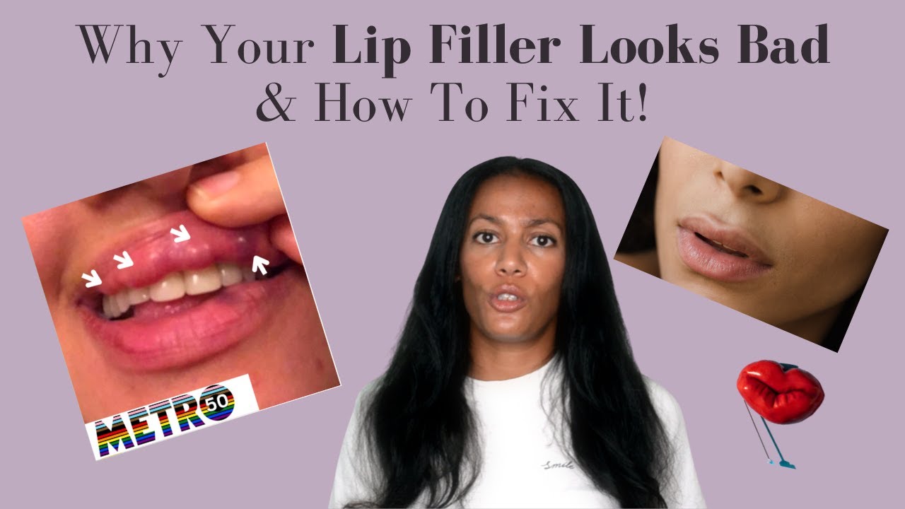 Bad Lip Fillers
