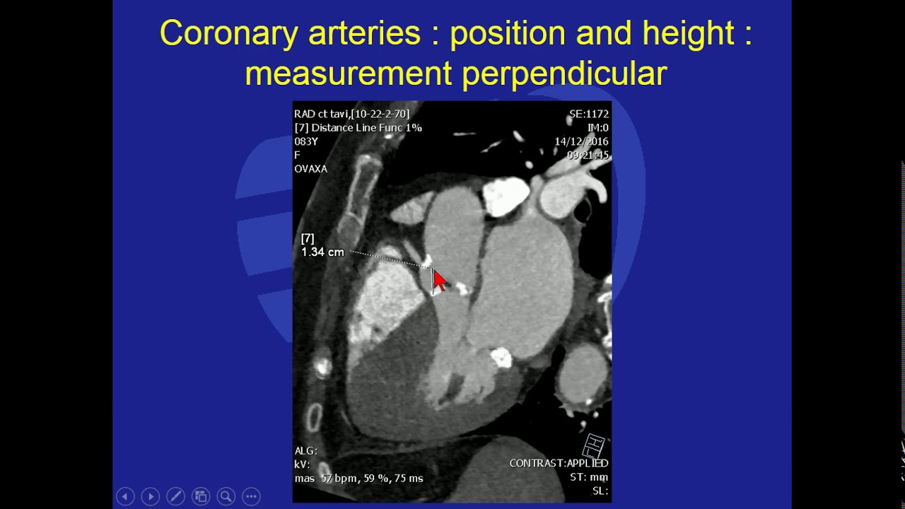 14.40-14.50: Using CT for TAVR Planning Preformed by the Surgeon, Filip ...