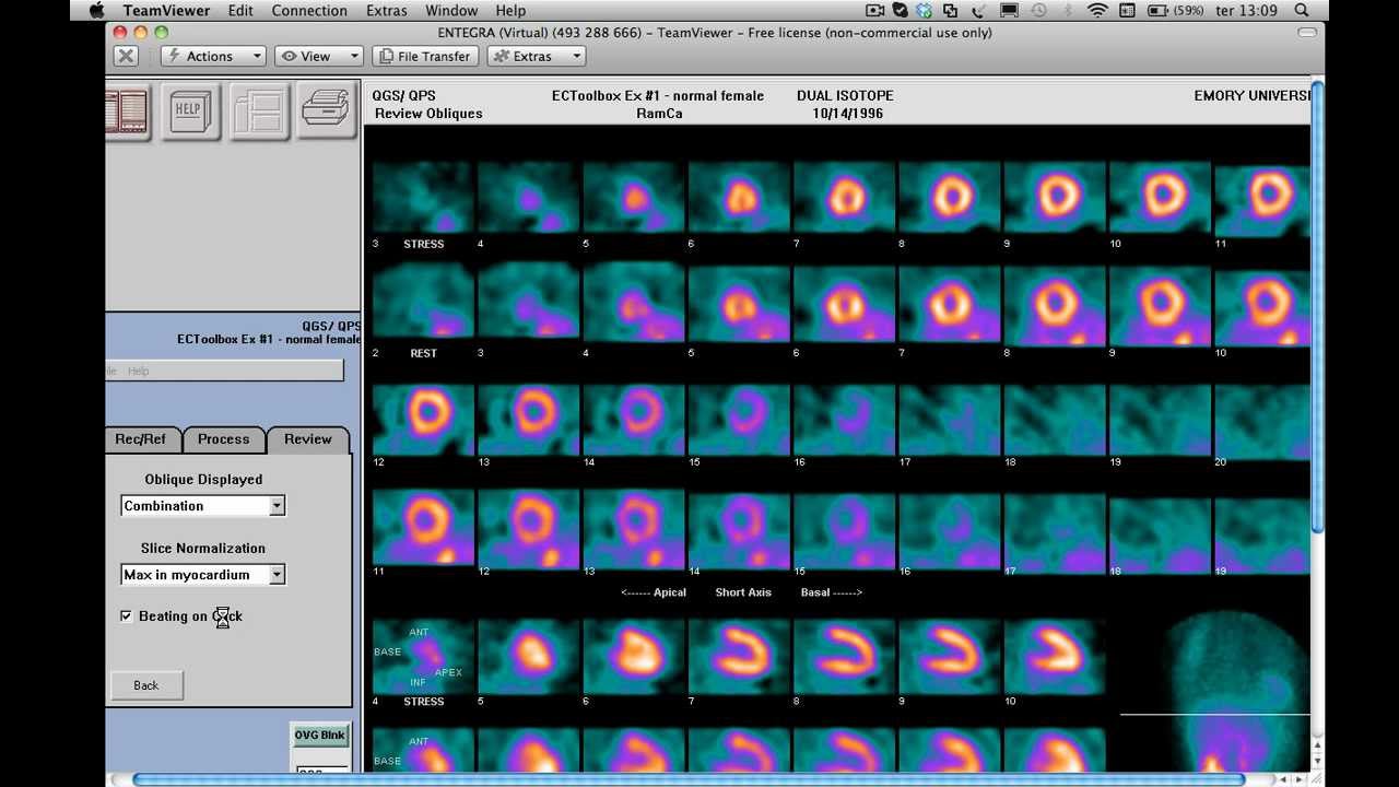 Entegra Nuclear Medicine Image Processing (numa máquina virtual) - YouTube