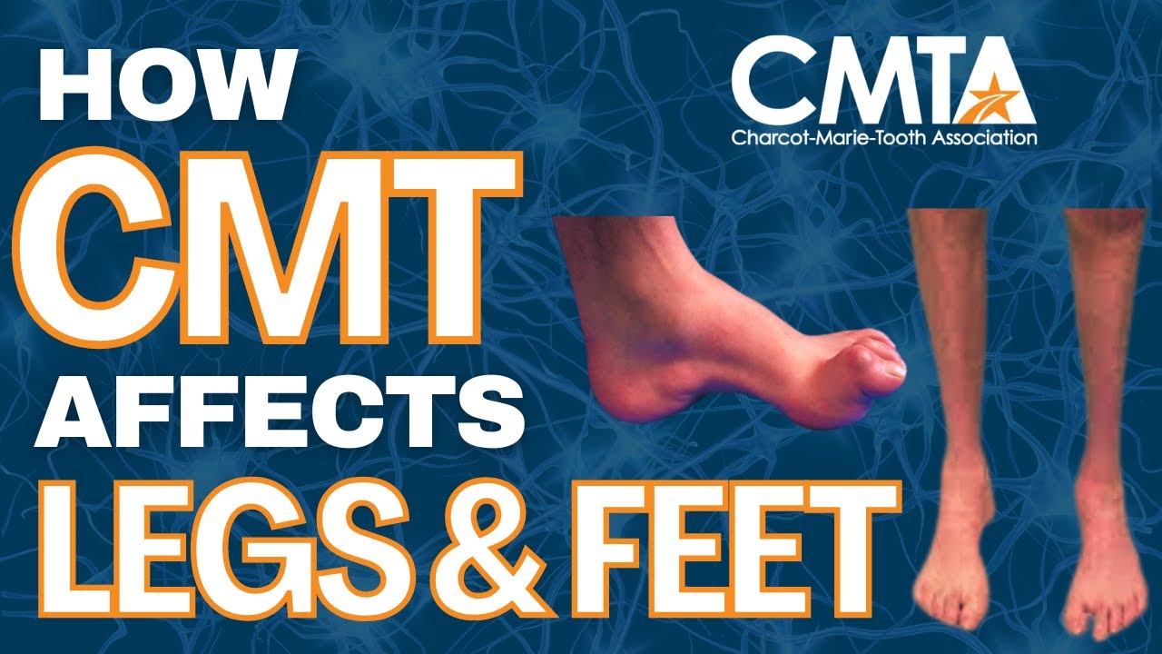 How Charcot-Marie-Tooth Disease (CMT) Affects Legs & Feet | Why Ankle ...