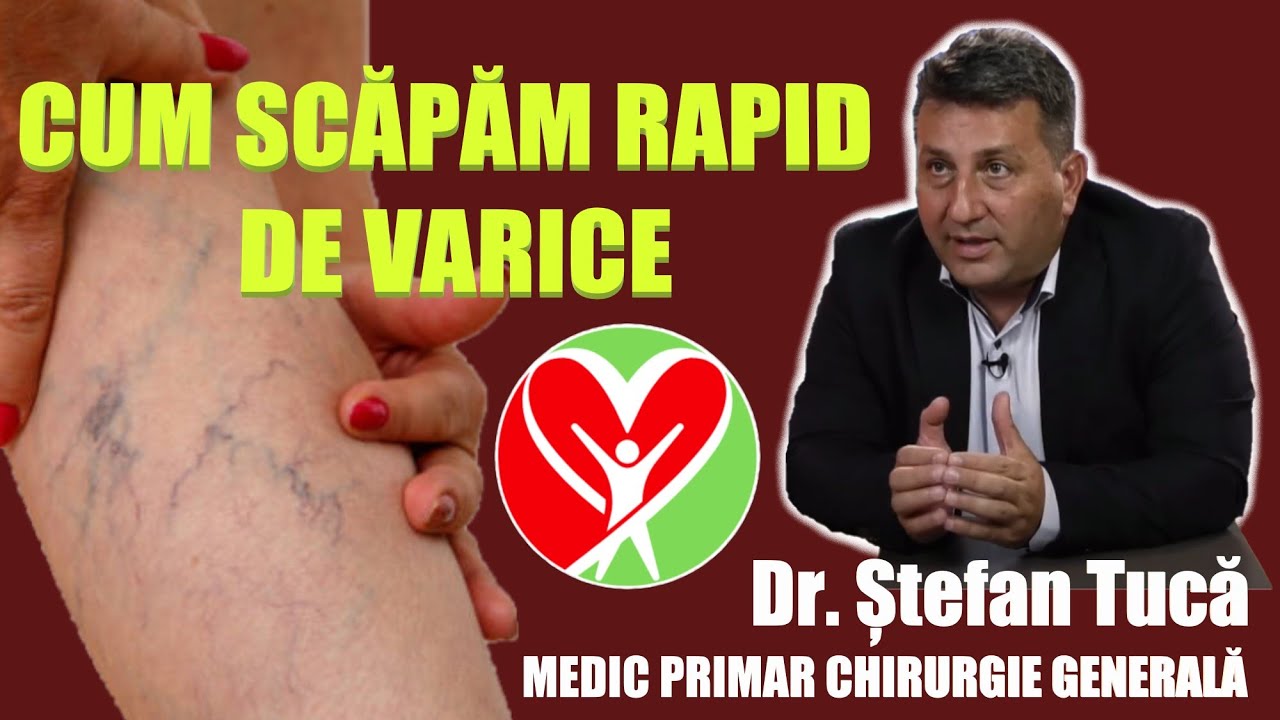 Cum scăpăm rapid de varice | Dr. Ștefan Tucă - Medic Primar Chirurgie ...
