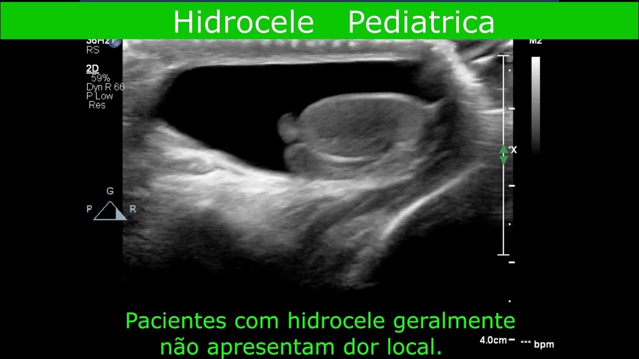 Ultrassonografia Bolsa Testicular Youtube