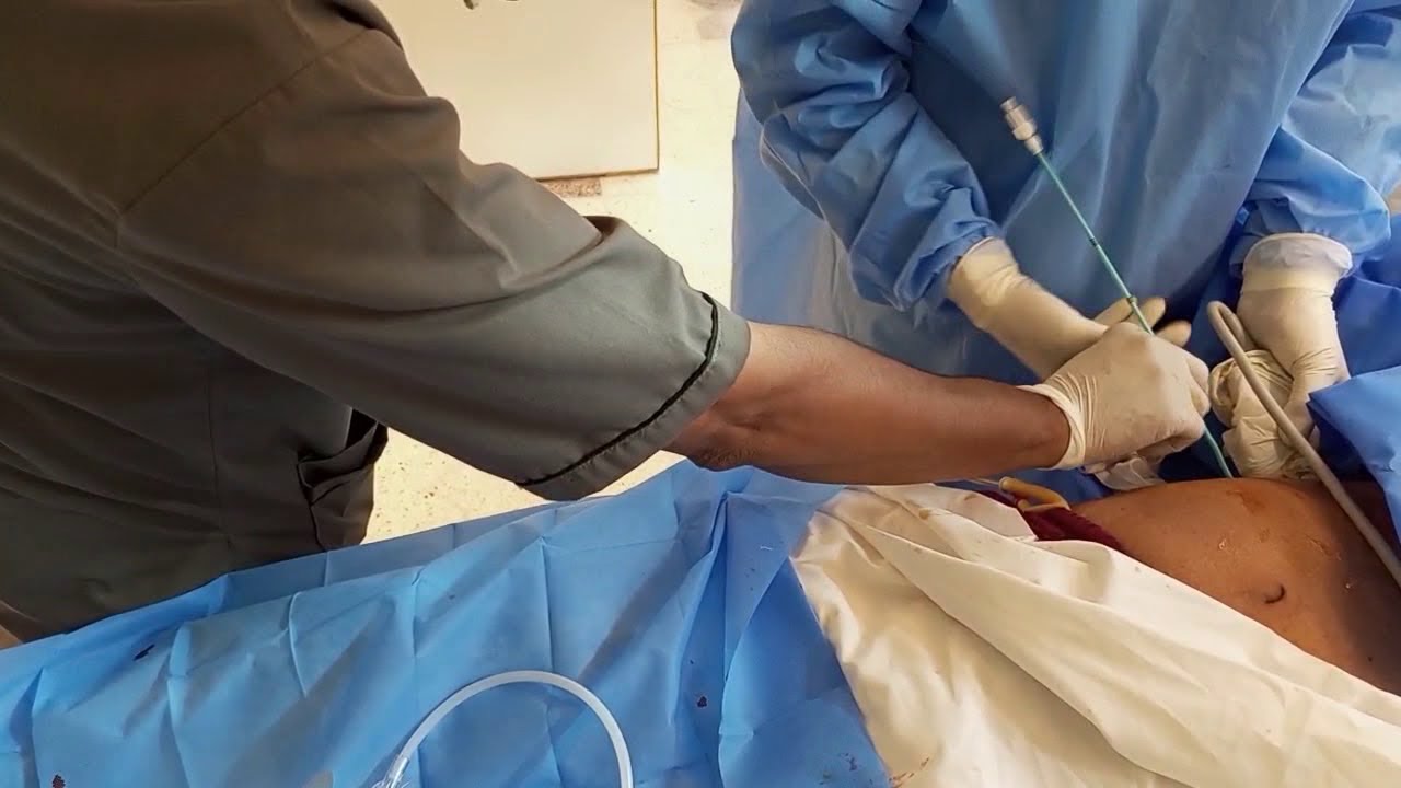 PCN Catheter)How to insert Percutaneous Nephrostomy Catheter in Human ...
