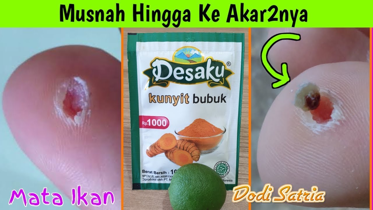 Cara Paling Ampuh Menghilangkan Mata Ikan Dengan Aman Sampai Akarnya Copot Sendiri - YouTube