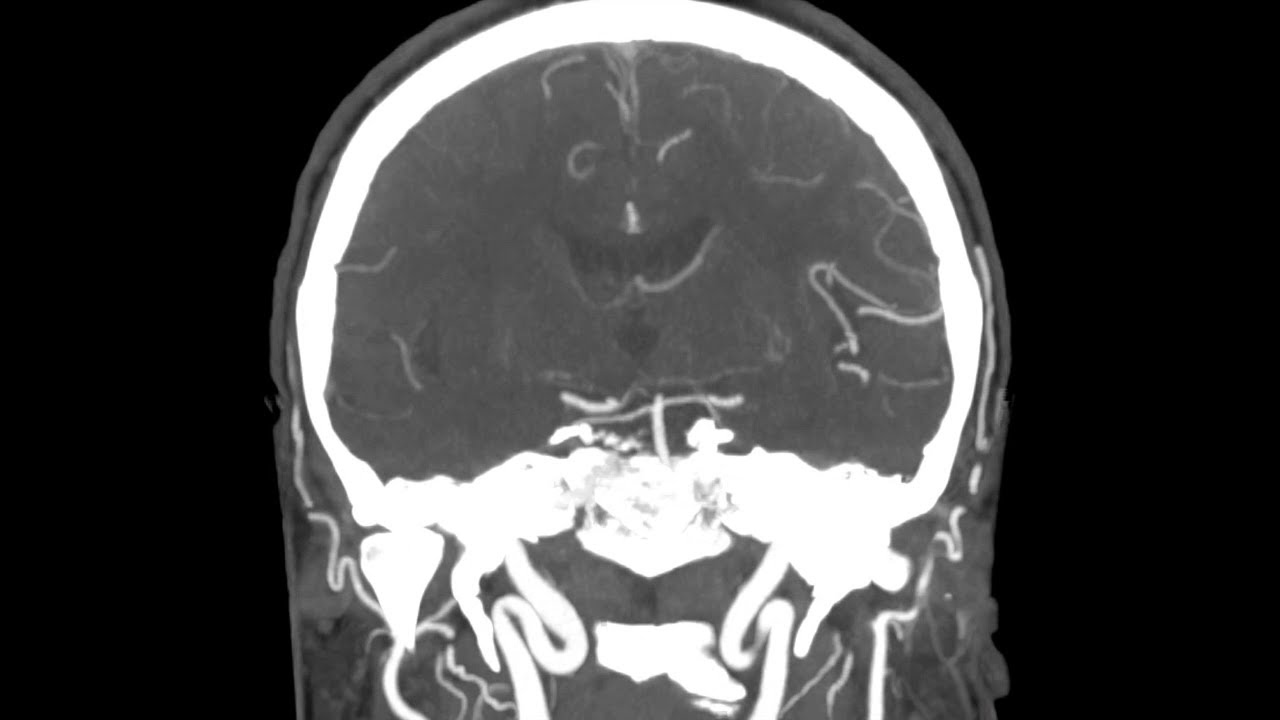 Stroke. Right MCA Occlusion. Distal Aspiration + Stentriever - YouTube
