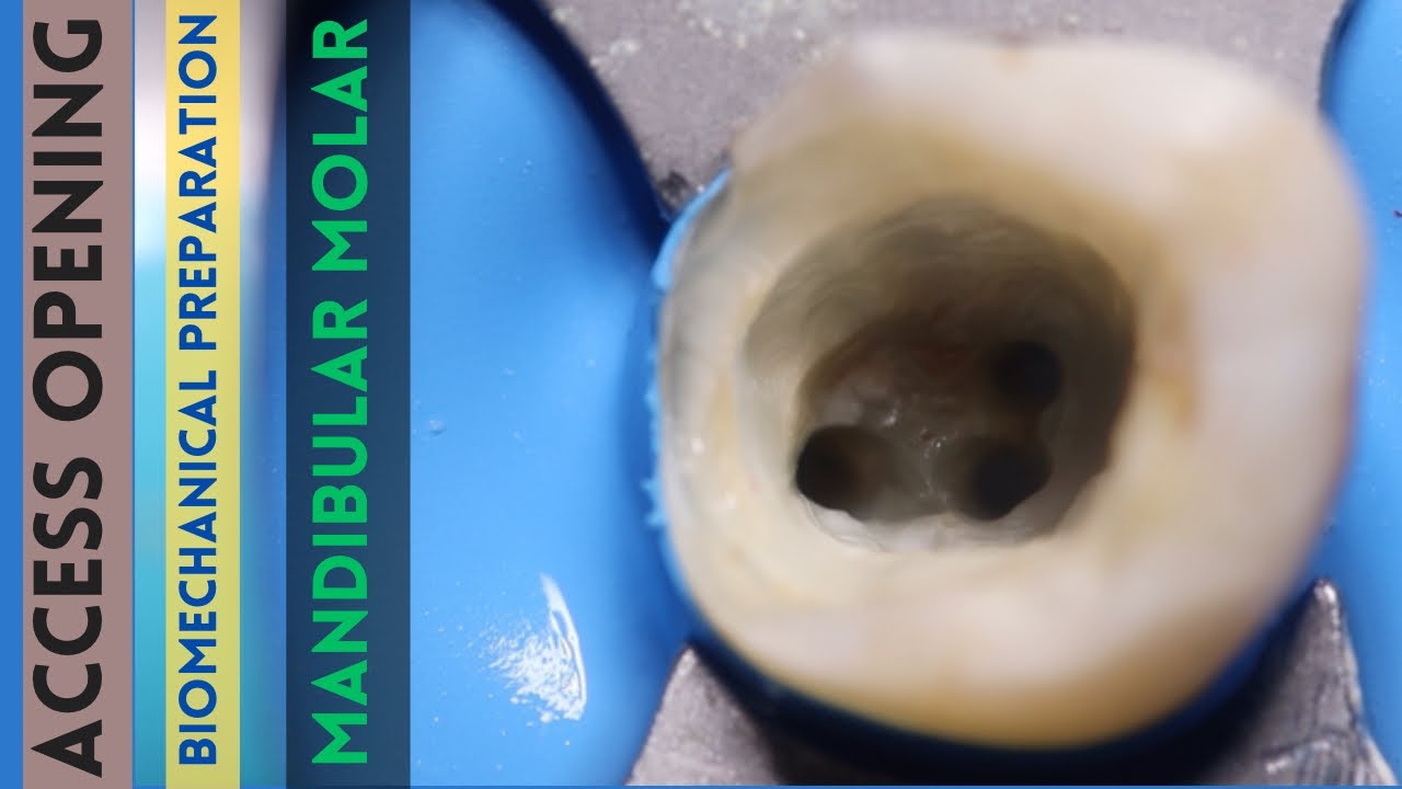 Access Opening & Biomechanical Preparation 🟡 mandibular molar with ...