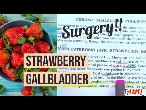 Strawberry Gallbladder 2M Previous Year Question|Surgery2|Mgr ...