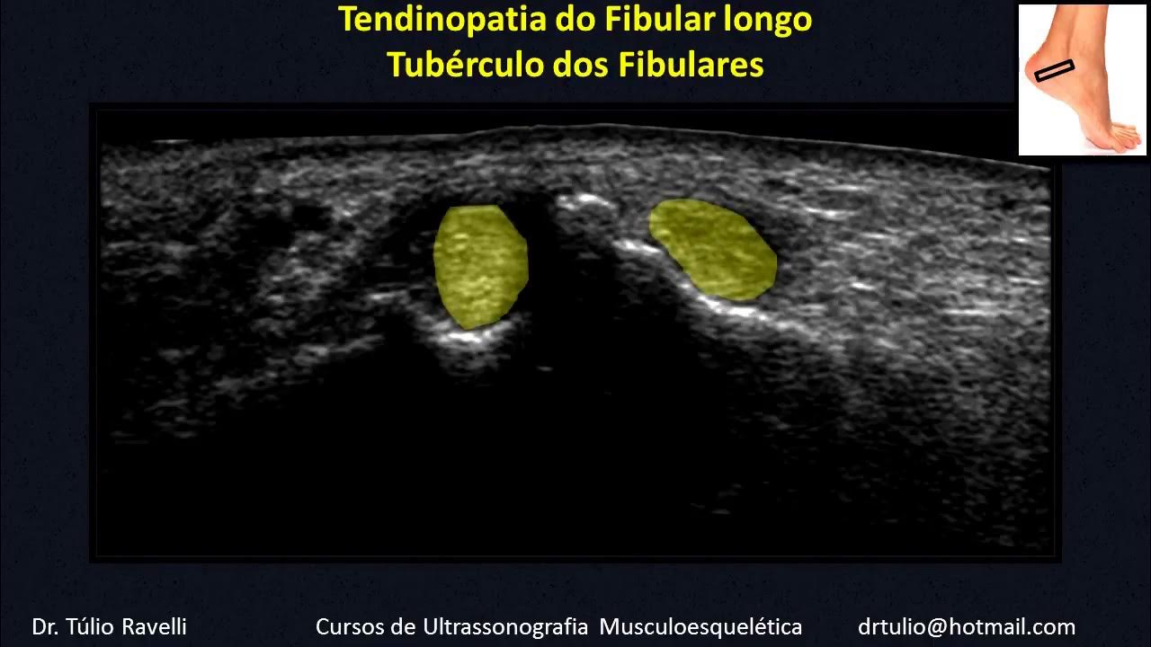 Ultrassom do Tornozelo - Tubérculo do Fibulares e Tendinopatia do Fibular longo - YouTube