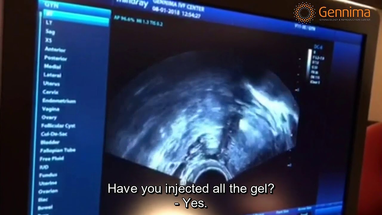 HyFoSy: a painless alternative to hysterosalpingogram using ultrasound ...