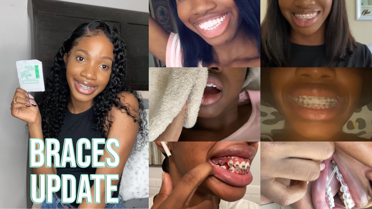 1.5 Year Braces Update: 4 Extractions, Rubber Bands, Overbite & More ...