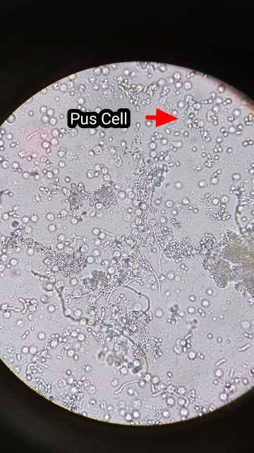 Microscopic Examination of Urine #urine #puscell #RBC - YouTube