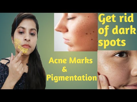 How to get rid of dark spots,acne Marks nd pigmentation |get clear skin ...