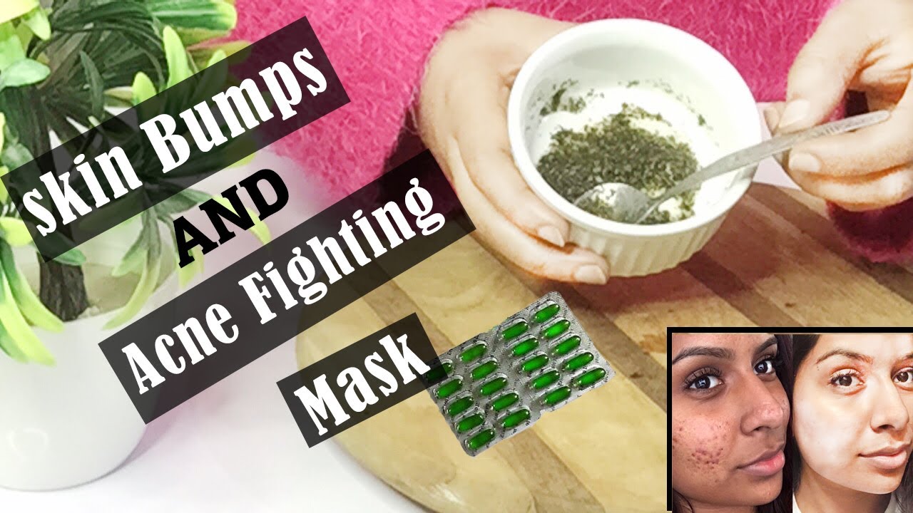 Most Powerful Mask Fight Acne/Skin Bumps | How To Get Rid Of Acne ...