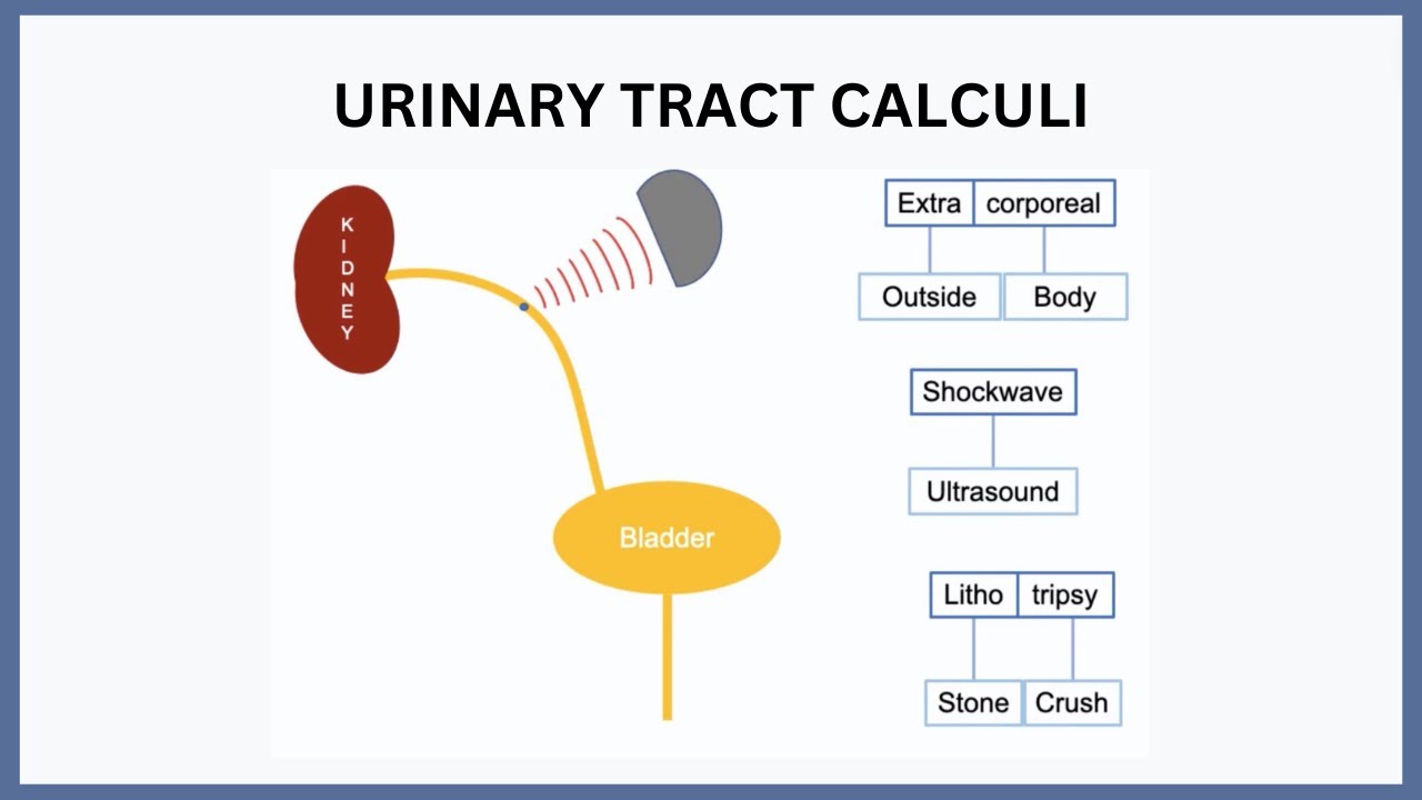 Urinary Tract Calculi Explained - YouTube
