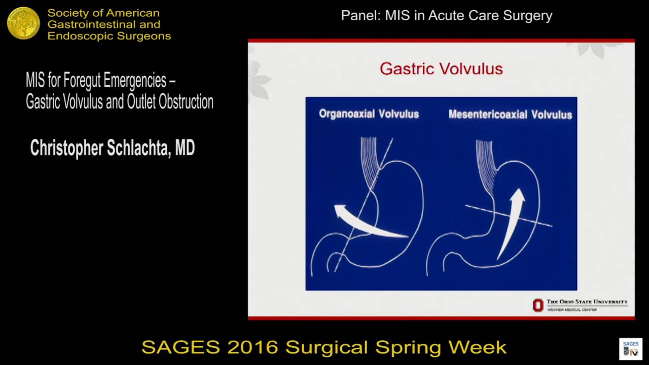 MIS for foregut emergencies - gastric volvulus and outlet obstruction ...