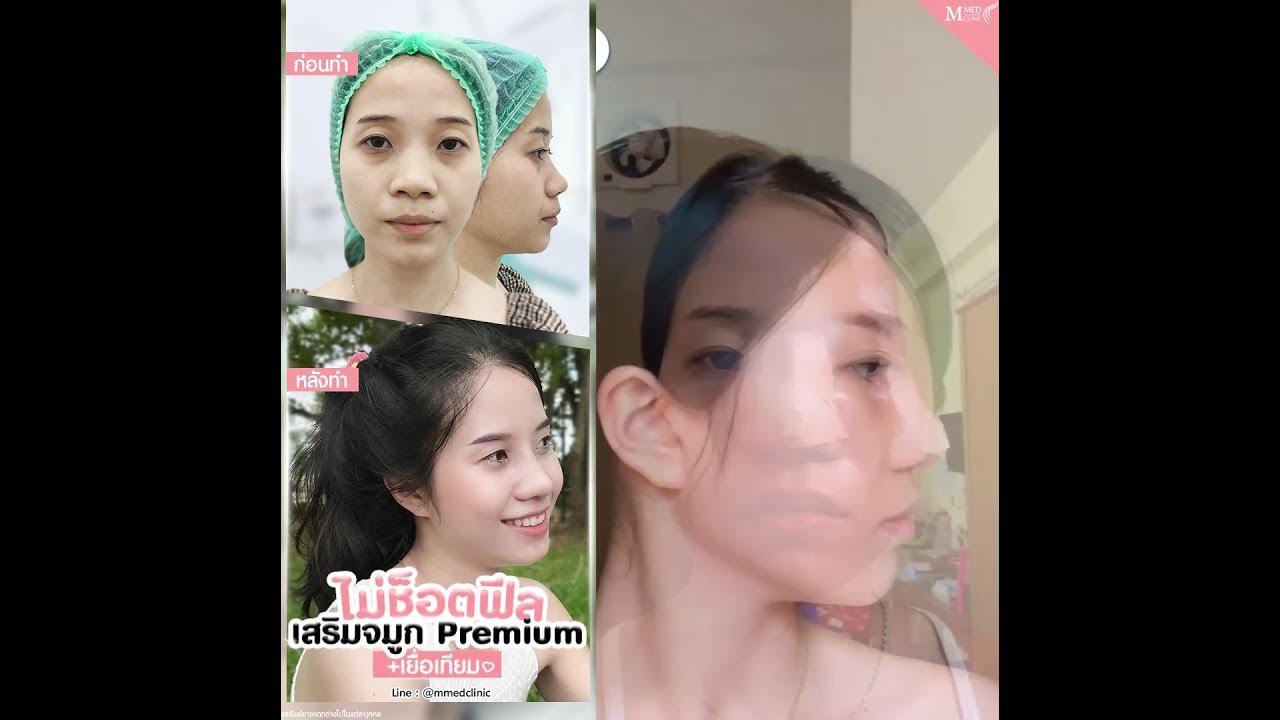คุณแอน เสริมจมูกพรีเมี่ยม เยื่อเทียม Youtube