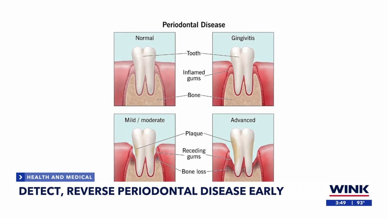 Detect and reverse periodontal disease early - YouTube