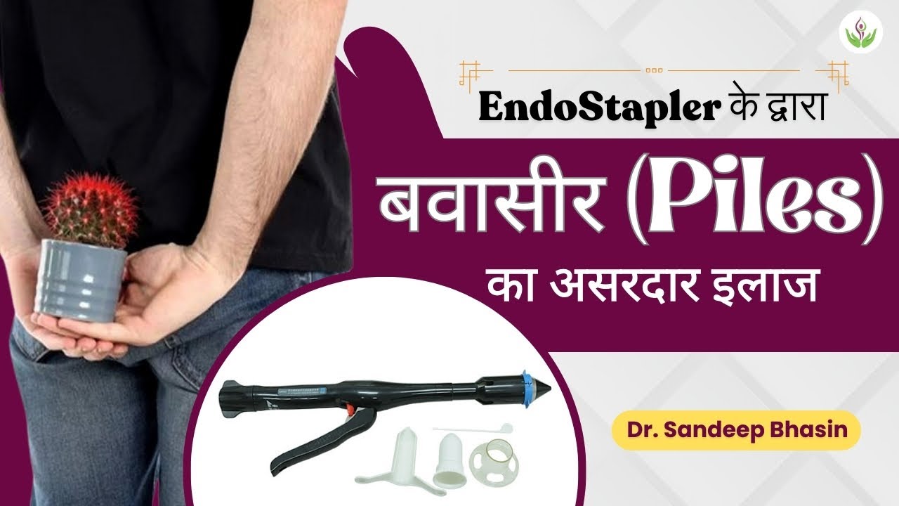 Endostapler से बवासीर का स्थायी और दर्द-रहित इलाज | Permanent ...