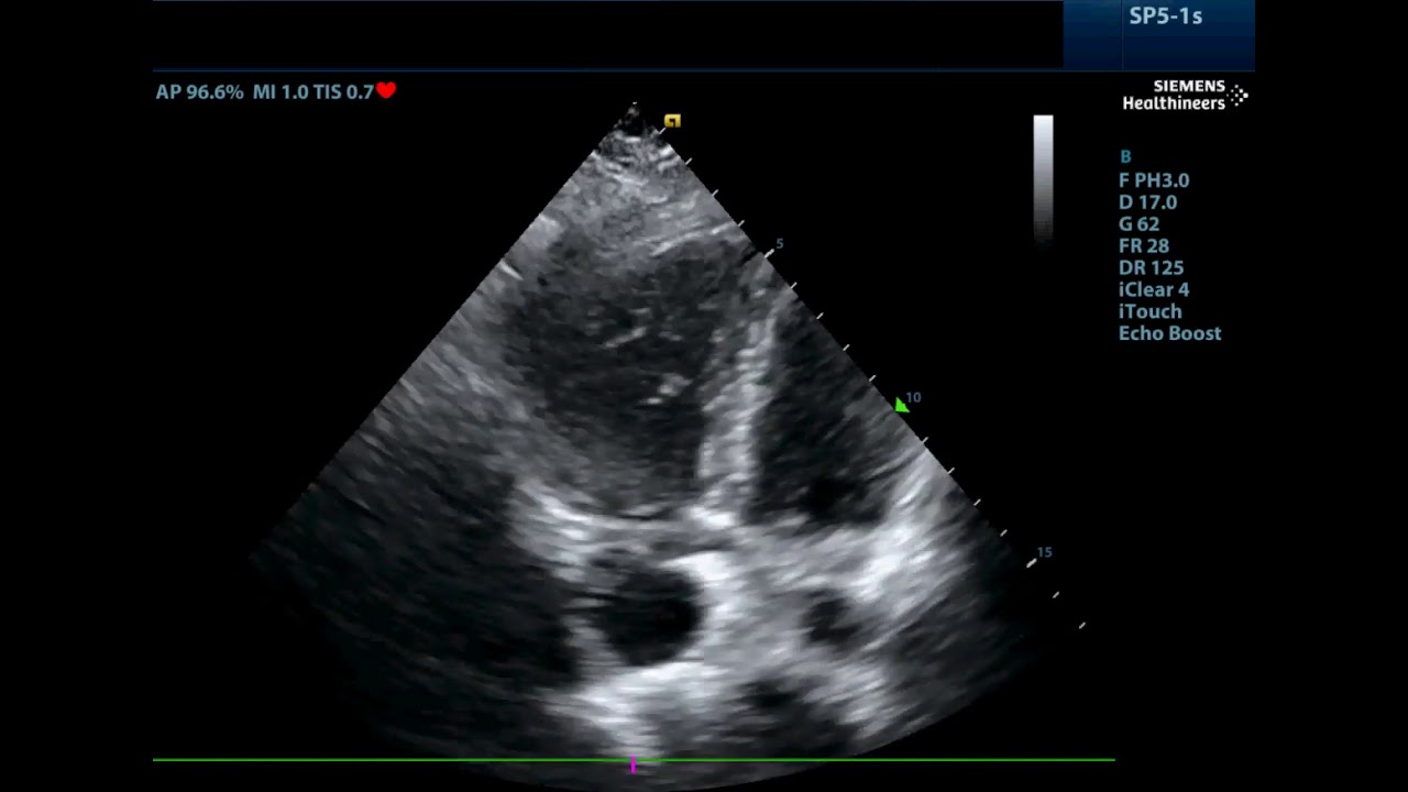 Modified apical 4 chamber view - YouTube