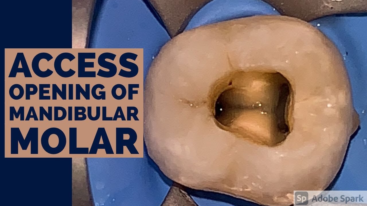 Access Opening of Mandibular Molar - YouTube