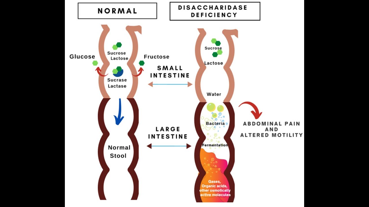 Disaccharidase Enzymes deficiency ; Definition, Types, Causes, Symptoms ...