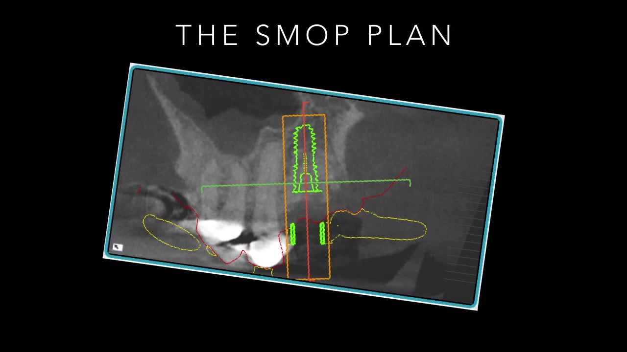 Last 50 Smop Implants 2017 - YouTube