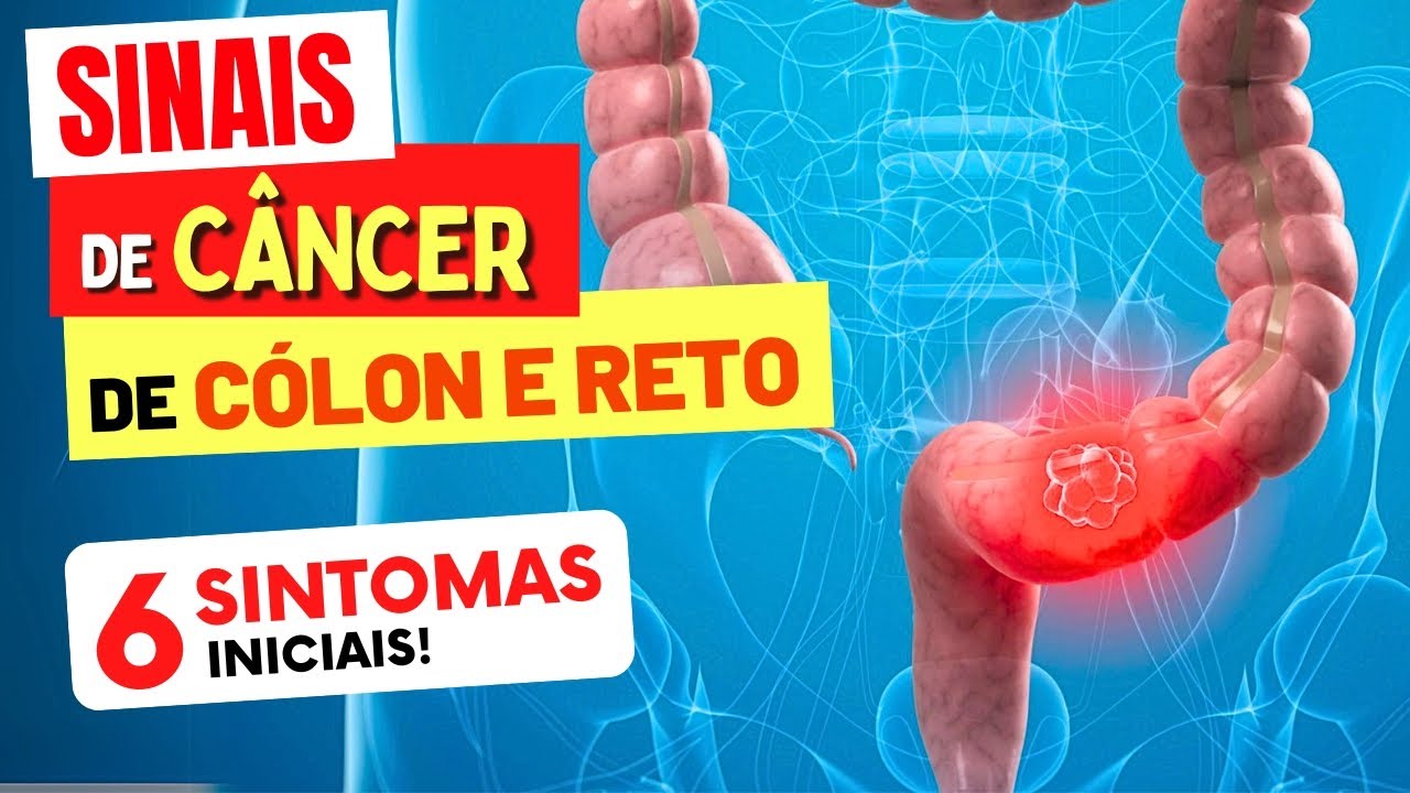 6 SINTOMAS INICIAIS de CÂNCER de CÓLON e RETO que você NÃO PODE IGNORAR ...