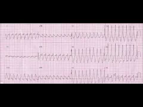 9.Κοιλιακη Ταχυκαρδια - YouTube
