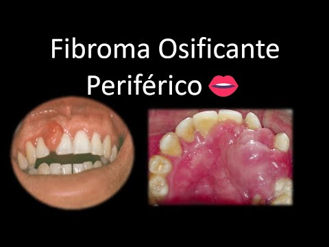👄 Fibroma osificante periférico - Cavidad oral - Cabeza y Cuello ...