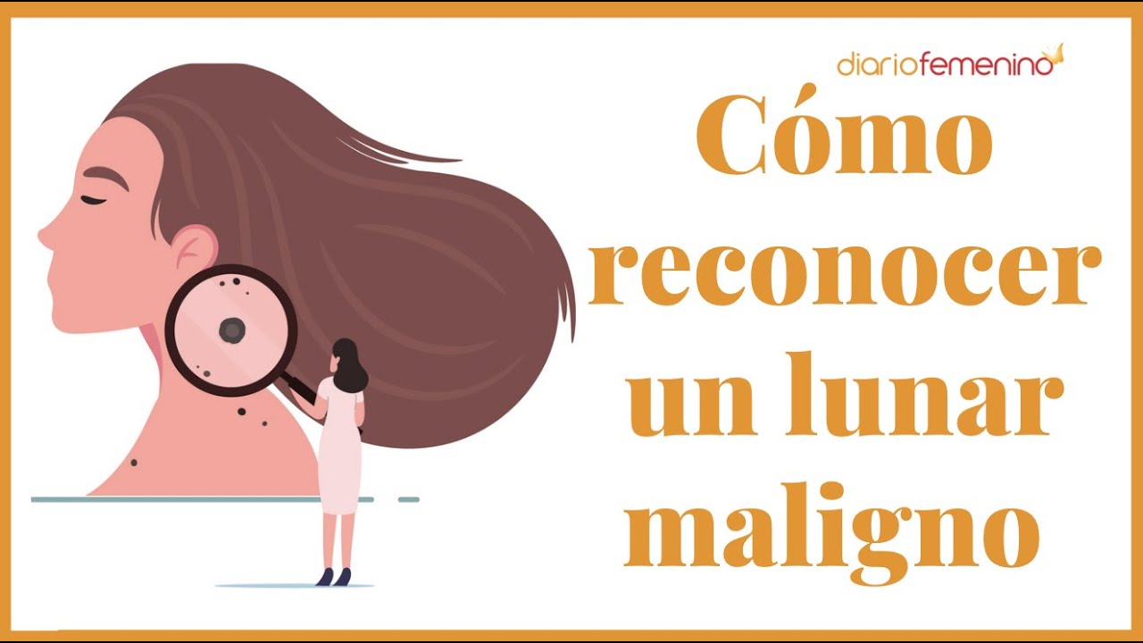 ¿Cómo saber si un lunar es maligno o benigno? La efectiva regla ABCDE ...