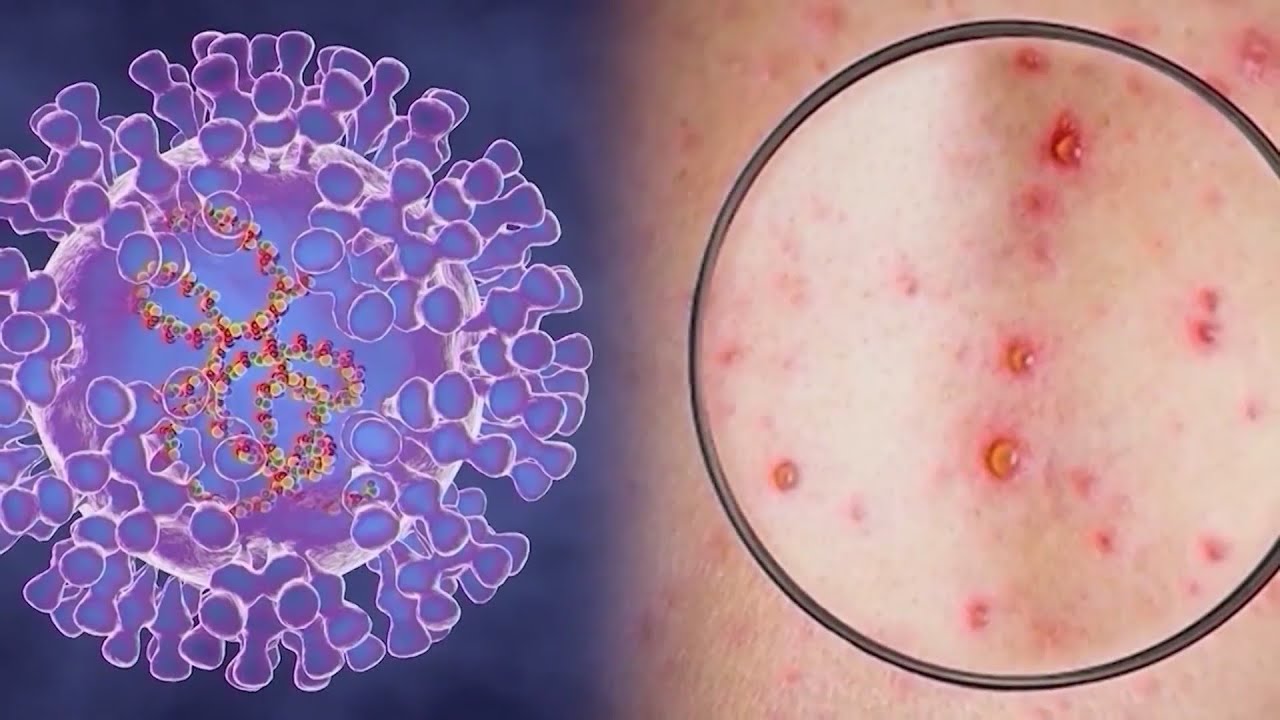 Monkeypox disproportionately affecting people of color, data shows ...