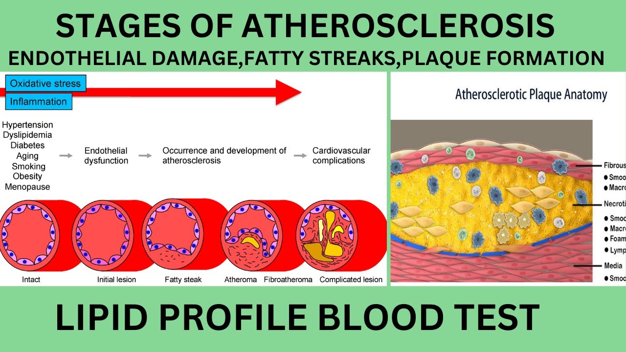 Stages of Atherosclerosis. Pathogenesis Of Atherosclerosis.Endothelial ...
