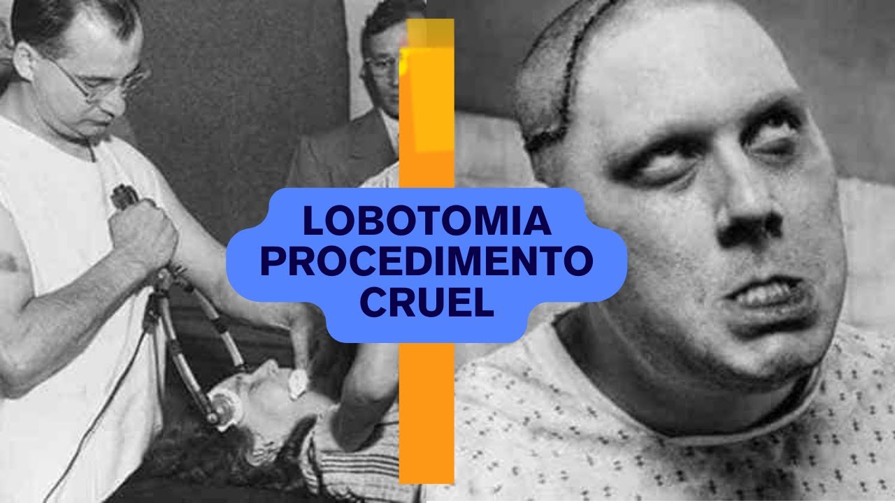 FATOS ASSUSTADORES SOBRE A LOBOTOMIA - YouTube