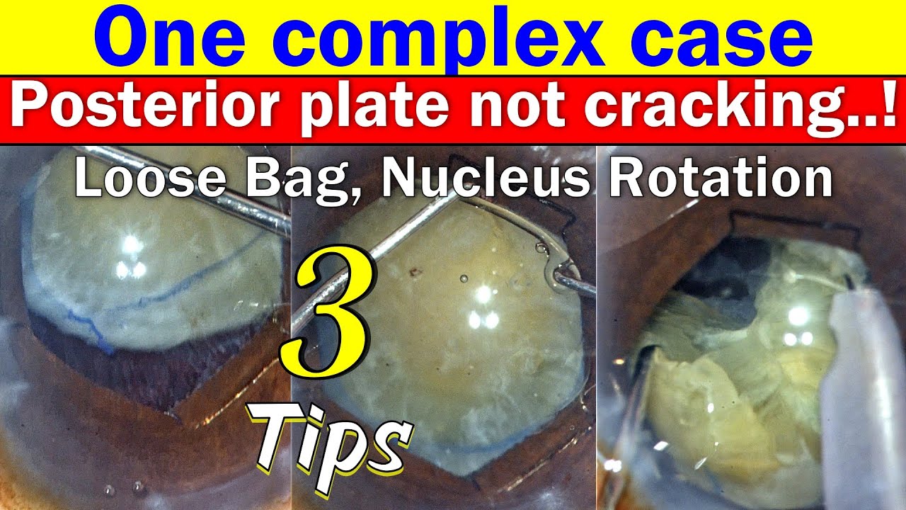 One Complex Case and 3 tips. Phacoemulsification in an eye with PEX ...