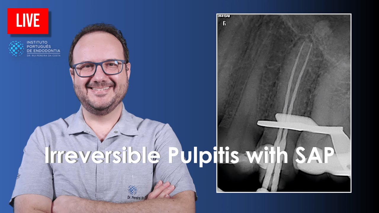 🔴Endo Tx - Long 25 with Symptomatic Apical Periodontitis ️ PT Ultimate ...
