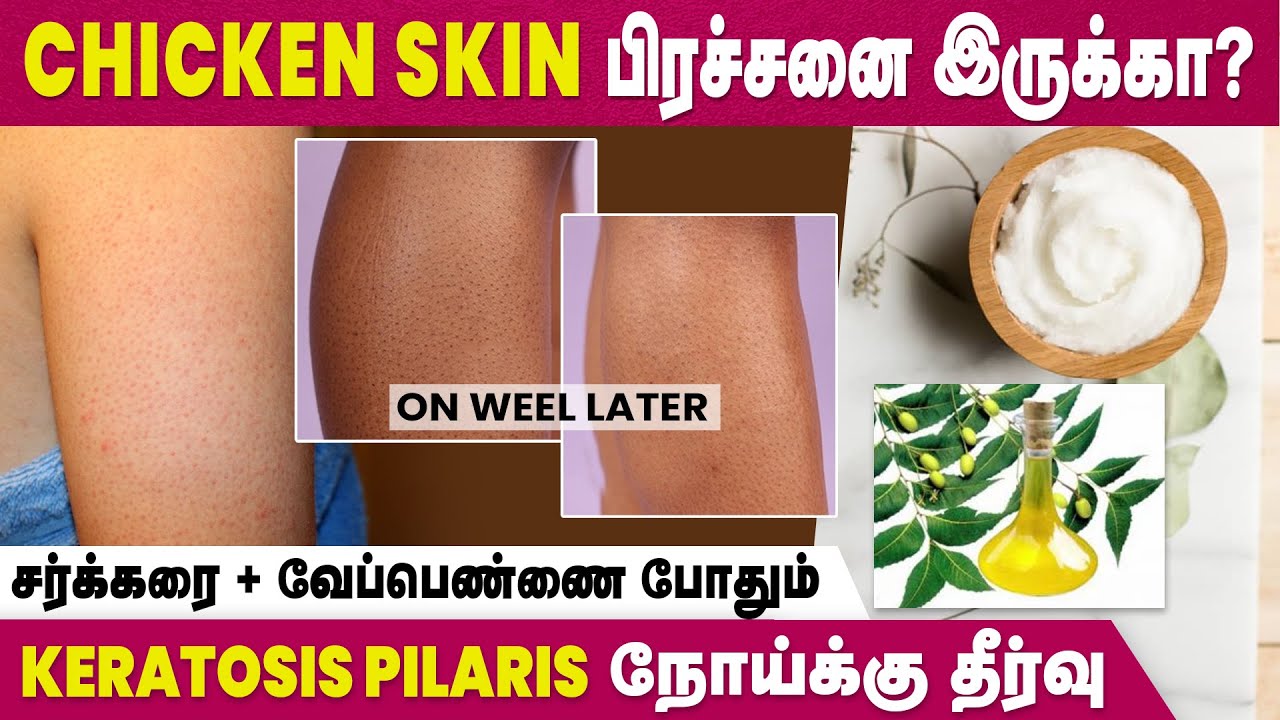 Affected By Keratosis Pilaris Disease? | Home Remedies To Cure Chicken ...