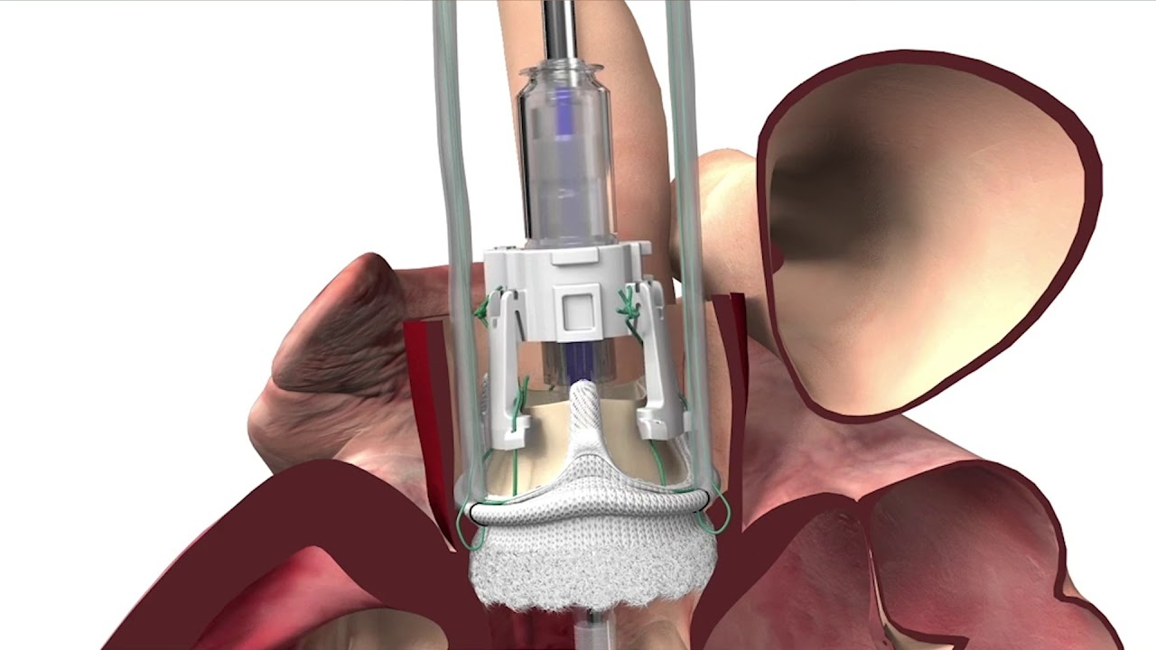 Intuity Valve Procedure for Aortic Stenosis - YouTube