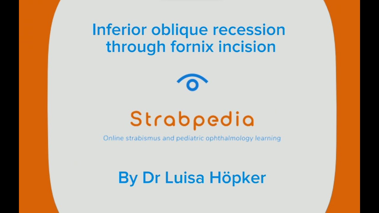 Inferior oblique recession through fornix incision - YouTube