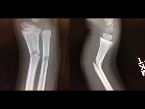 angulated forearm fracture - YouTube