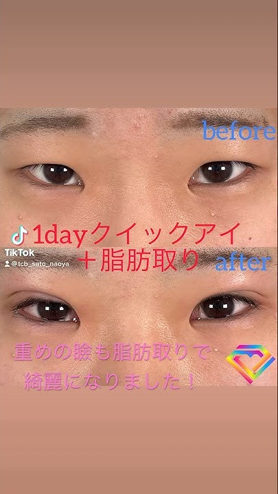 #tcb式1dayクイックアイ #tcb #tcb二重埋没症例 #アイプチ #プチ整形 #モニター募集 #二重 #二重になりたい #shorts - YouTube